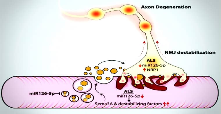 Tratamiento de la esclerosis lateral amiotrófica ALS.